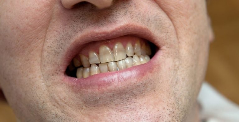 Smokers Teeth: The Hidden Consequences of a Common Habit